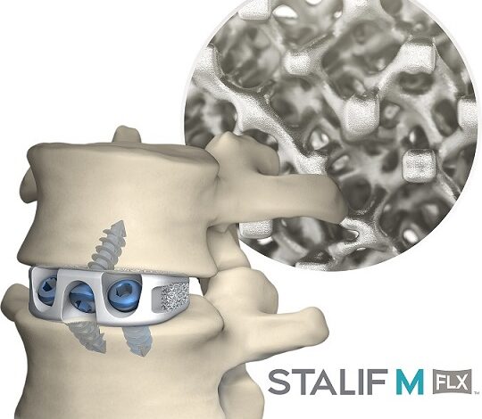 Centinel Spine's STALIF M FLX™ Listed as Top ALIF 3D-printed Cage ...