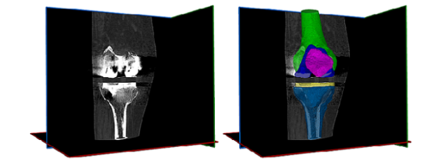 RSIP Vision Unveils Robust Metal Implant & Anatomical Segmentation Tool ...