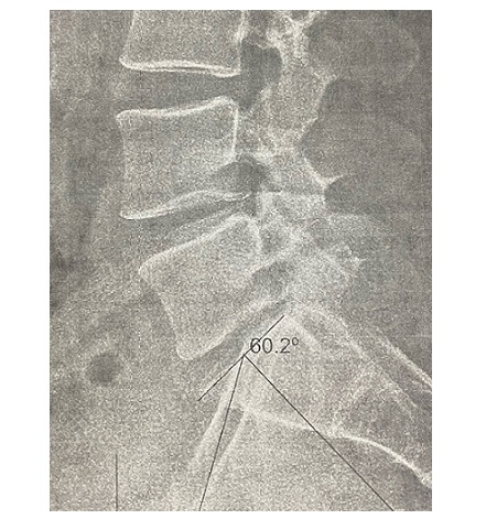 First Two-Level Lumbar Disc Replacement Performed In Metro DC, Maryland ...