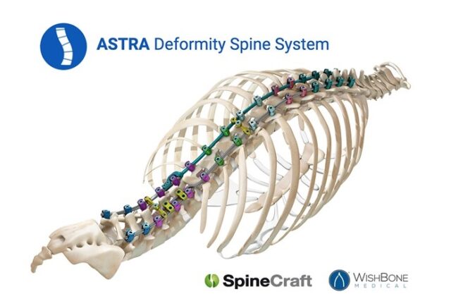 SpineCraft and WishBone Medical Enter Distribution Agreement to ...