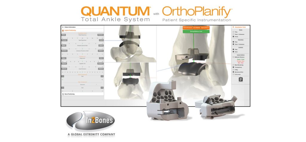 In2Bones Receives FDA Clearance for Pre-Surgery OrthoPlanify Patient ...