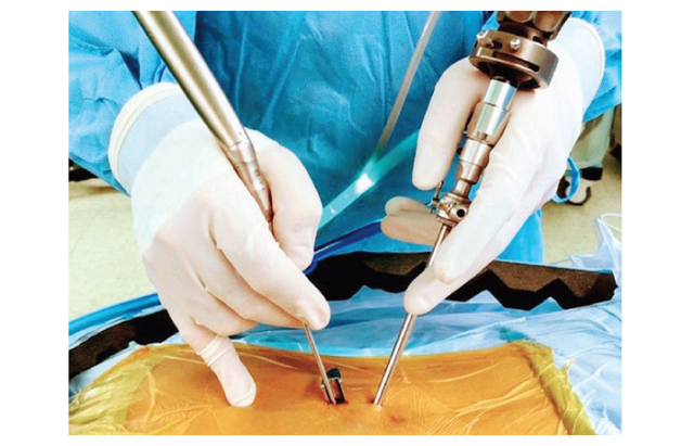 Amplify Surgical®, Inc. Announces FIRST dualPortal™ Endoscopic Spine ...