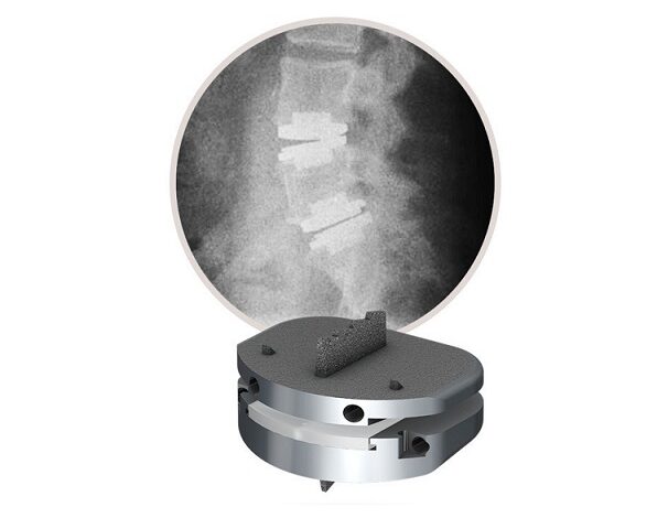 New CPT Add-on Code Accepted for Second Level of Lumbar Total Disc ...