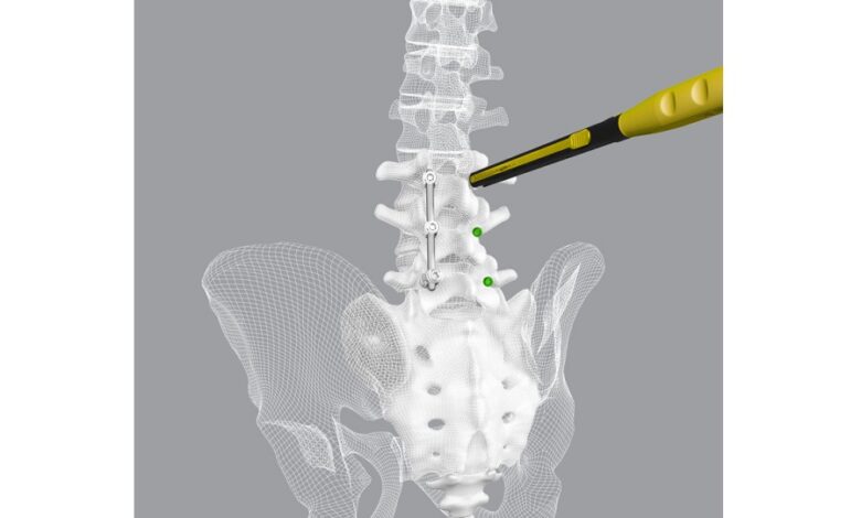 CoreLink Announces Commercial Launch Of CentraFix™ Midline Fixation ...