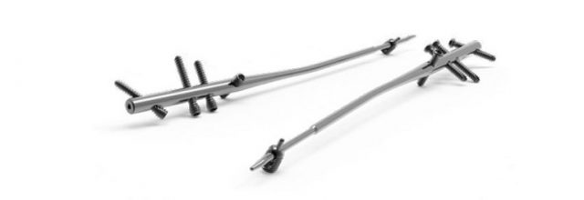 Acumed Launches the Ulna Nail 2 System to Offer More Choice in Treating ...