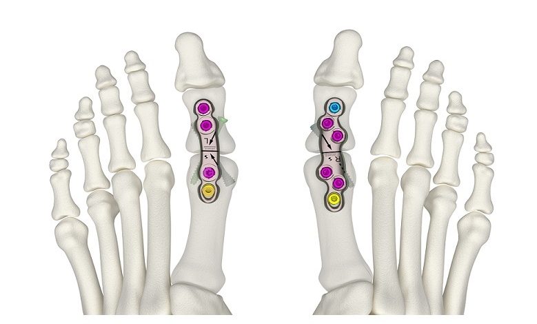 OrthoSolutions Introduces the Volition™ MTPJ Plating System Featuring V ...