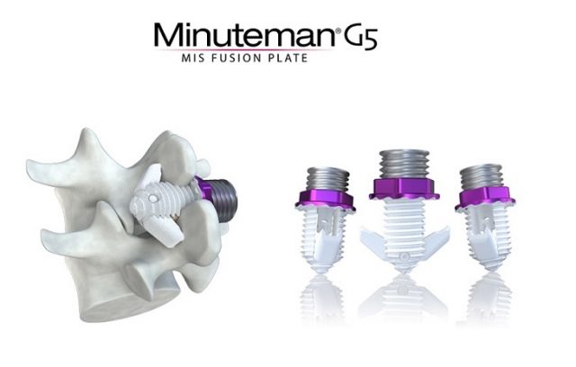 Spinal Simplicity Announces the launch of the Minuteman® G5 Implant ...
