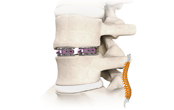 NEUROSTRUCTURES, INC. grows Patent Portfolio with Pronaos™ Expandable ...