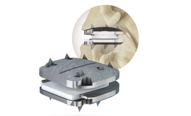 Centinel Spine® Announces First Commercial Use of the prodisc® C Vivo ...