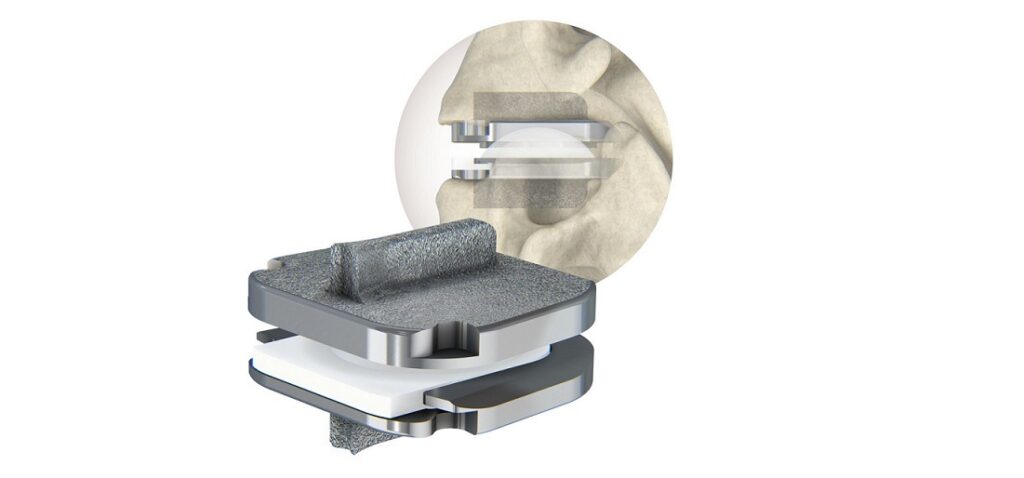 Centinel Spine® Announces First Commercial Use of prodisc® C SK ...