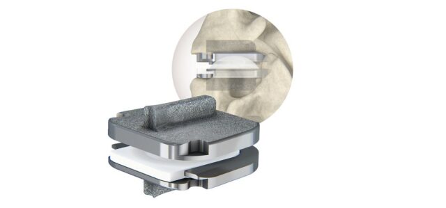 Centinel Spine® Announces First Commercial Use of prodisc® C SK ...