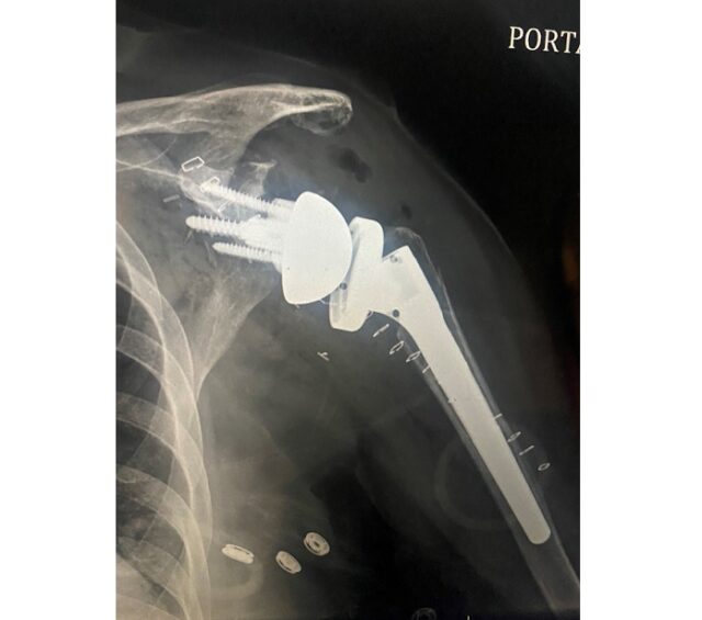 CurvaFix Receives FDA Clearance for Smaller-diameter, Intramedullary ...