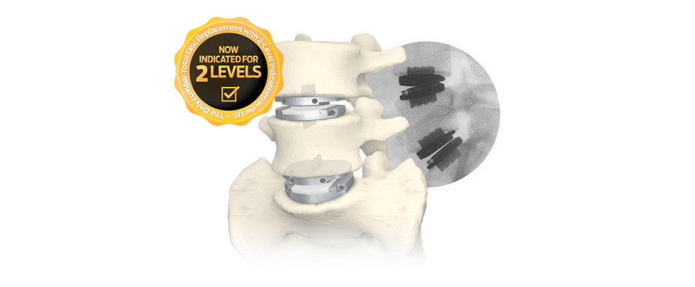 New CPT Code Now Effective for Second Level of Lumbar Total Disc ...