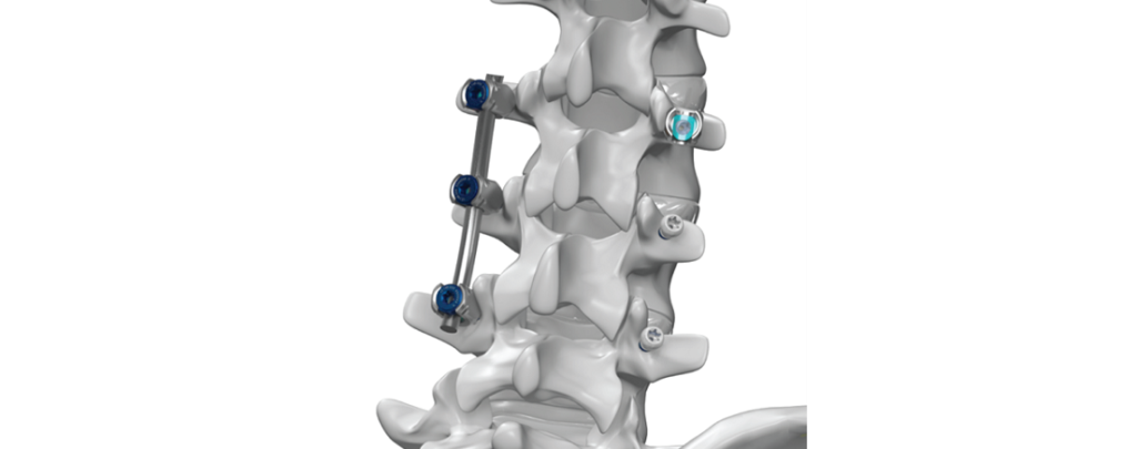 Life Spine Announces First Surgical Cases of ARx® Spinal Fixation ...