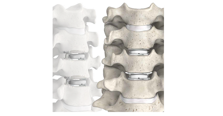 ZimVie Announces Over 200,000 Cervical Discs Have Been Replaced with ...
