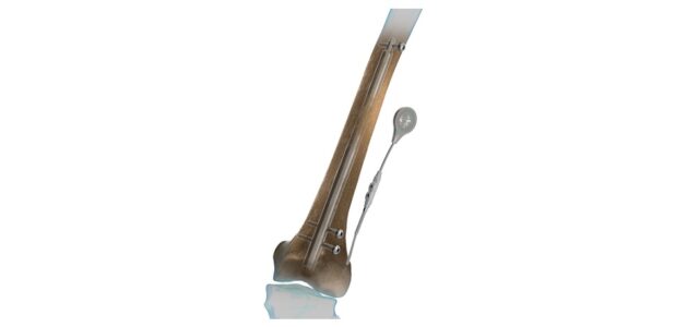 Orthofix Announces More Than 5,000 Fitbone Intramedullary Limb ...