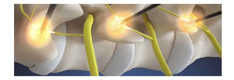 Stratus® Medical announces first patient enrolled in important double ...