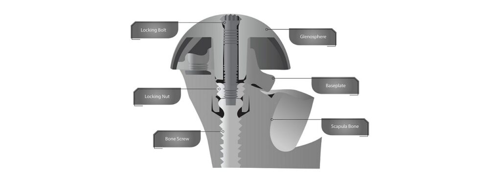 Shoulder Innovations Announces Additional Patent For InSet™ Reverse ...