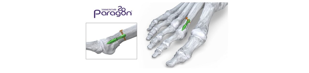 Paragon 28 Launches Phantom® Metatarsal Shortening System – Ortho Spine ...
