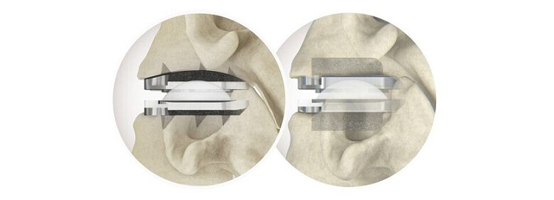 Centinel Spine® Quickly Achieves 1,000 Procedures with prodisc® C Vivo ...