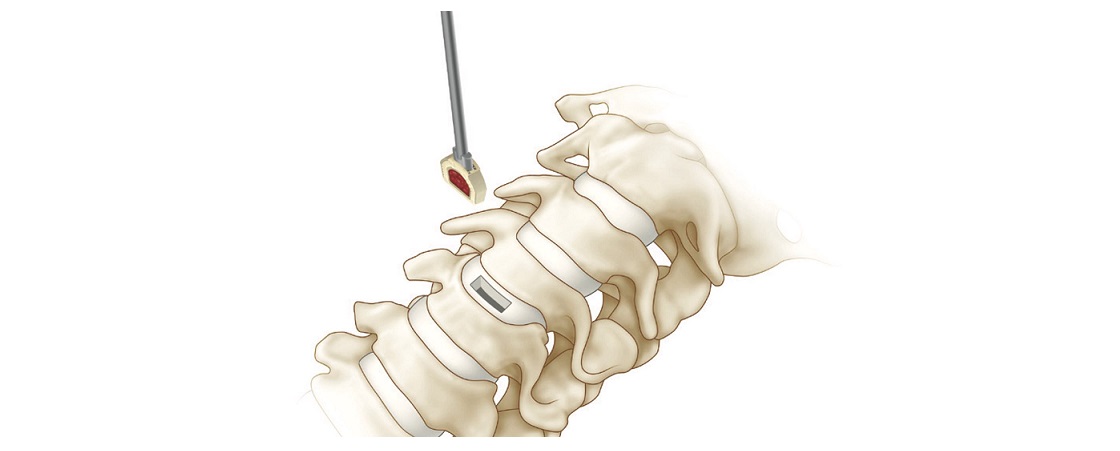 HAPPE Spine Announces FDA Clearance for the INTEGRATE-C™ Interbody ...