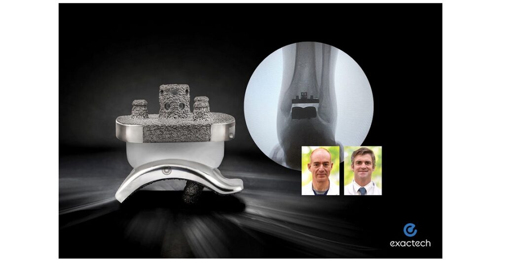Exactech Announces First Total Ankle Surgeries in South America – Ortho ...