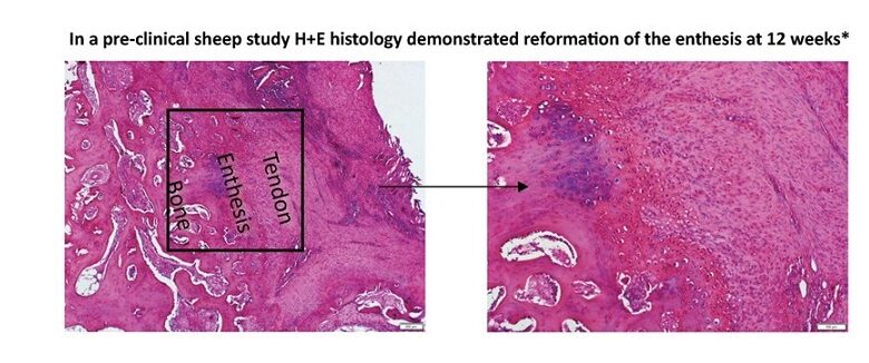 First Surgical Procedures In The World Using Tetrous EnFix RC™ Fiber ...