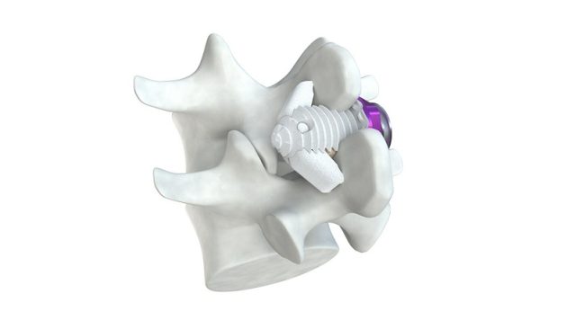 Pixee Medical: Revolutionizing Total Shoulder Arthroplasty with Cutting ...