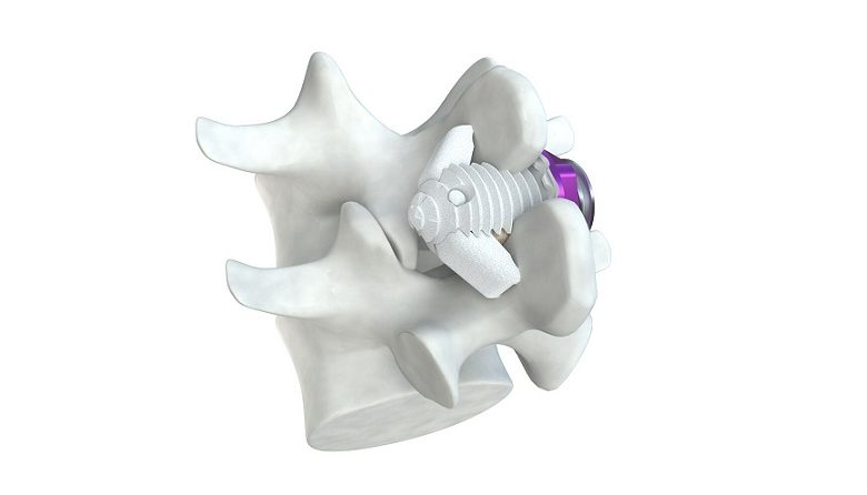 Spinal Simplicity Announces New Real-World Fusion Study for Its ...