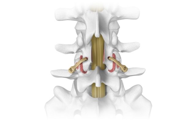 Premia Spine Launches FDA-Approved TOPS™ System at North American Spine ...