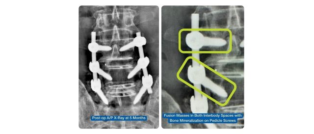 joimax® Launches New iLESSYS® Biportal Interlaminar Endoscopic Surgical System – Ortho Spine News
