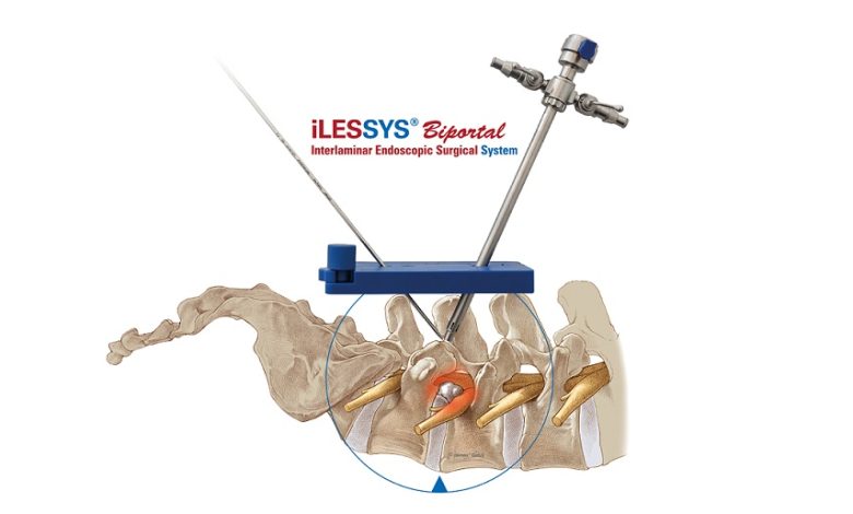 joimax® Launches New iLESSYS® Biportal Interlaminar Endoscopic Surgical System - Ortho Spine News