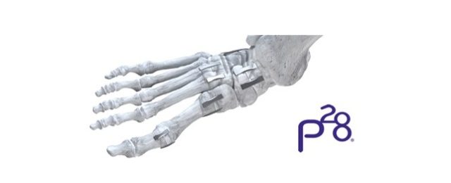 Paragon 28 Launches JAWS™ Great White Staple System Further Expanding ...