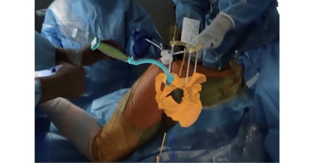 HipInsight System™ Hits 3,000 Total Hip Replacement Case Milestone ...