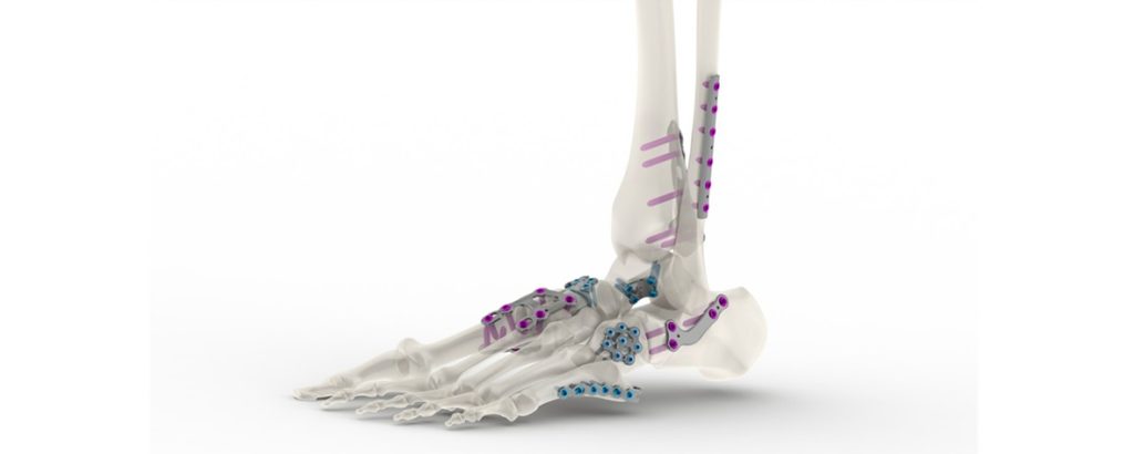 Tyber Medical Anatomical Plating System Cleared For Canada – Ortho ...