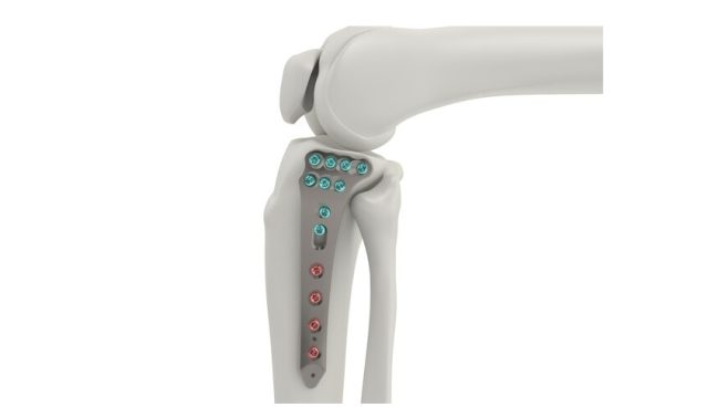 Tyber Medical Acquires FDA Clearance for Proximal Tibia Plating System ...