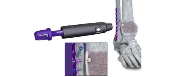 Paragon 28 Launches the R3FLEX™ Stabilization System to Anatomically ...