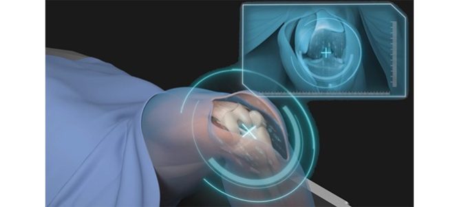 VISIE™ Inc. Announces Continuous Anatomic Auto Tracking (CAAT) for ...