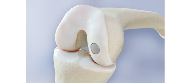 BioPoly® Knee FDA-Approved Clinical Study is Now Published on ...