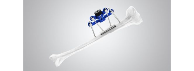 Orthofix Announces Global Commercial Launch of the TrueLok Elevate ...