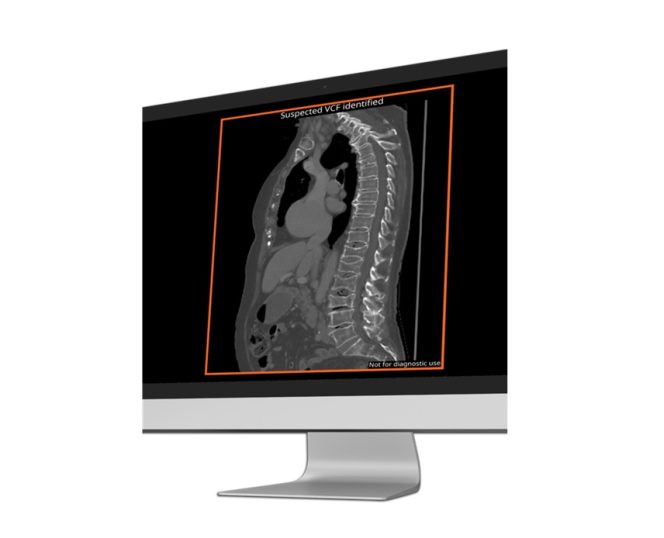 Centinel Spine® Continues to Innovate in Lumbar Total Disc Replacement ...