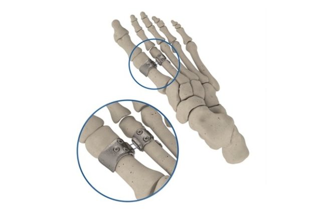 HyperFlex Medical Announces First Case in Clinical Evaluation of the ...