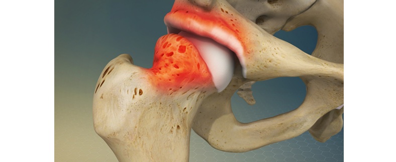 Foundation Surgical Announces First-Ever Surgery Using the Interwedge ...