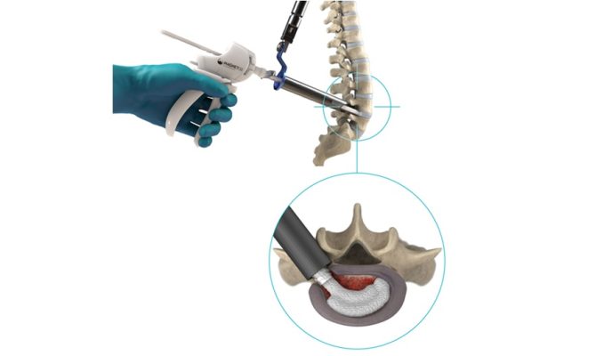 Kuros Biosciences debuts commercial launch of MagnetOs MIS Delivery ...