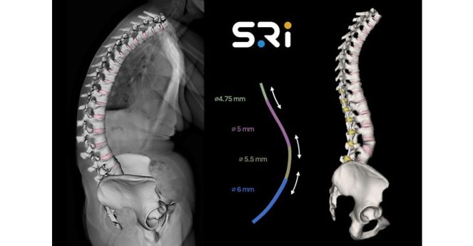 Notice of Allowability Issued for Variable-Dimension Fixation Rod and ...