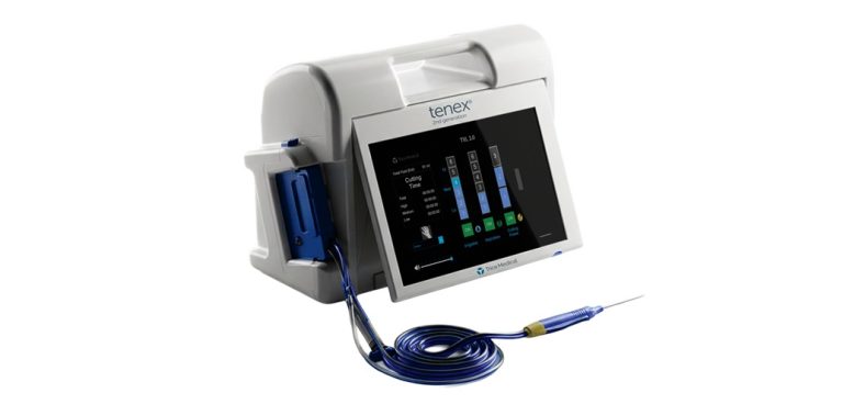 Trice Medical Launches Tenex® 2nd Generation Ultrasonic System ...