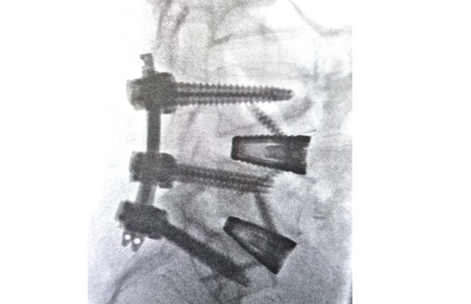 Spinal Elements Expands Ventana® Platform with FDA 510(k) Clearance and ...