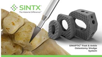 Trice Medical Launches Tenex® 2nd Generation Ultrasonic System ...