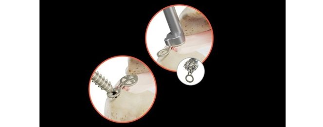 FDA Approves Expanded Clinical Applications for SINEFIX™ in Soft Tissue ...