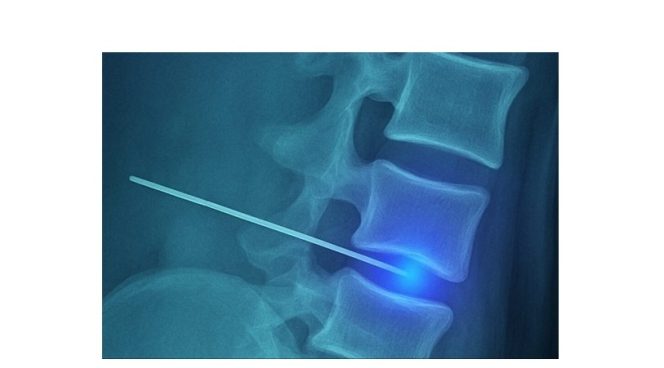 Xenix Medical Announces FDA Clearance and Full Commercial Launch of the ...